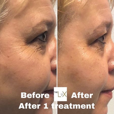 First Treatment Crows Feet Removal - The Lux Clinic