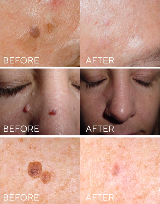 MOLE & SKIN LEISONS REMOVAL (after PROBLEMATIC SKIN TREATMENTS) - The ...